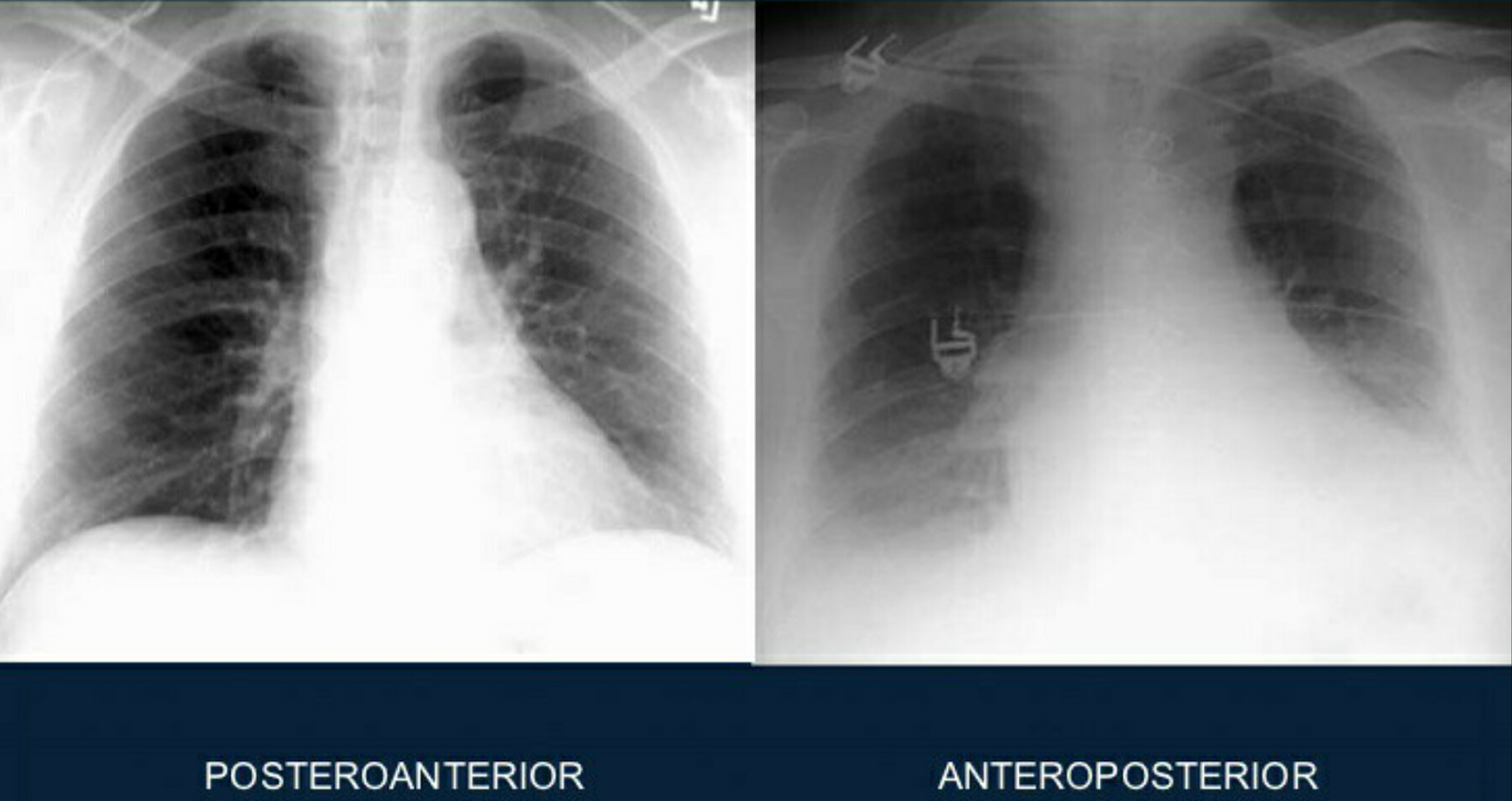 Praxis Médica: ¿Cómo diferenciar una radiografía AP de una PA?