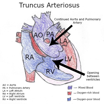Living the Diagnosis: I Choose to be Positive: A Truncus Arteriosus Story