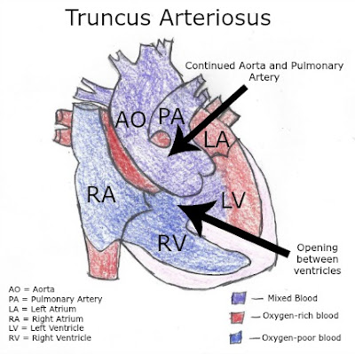Living the Diagnosis: I Choose to be Positive: A Truncus Arteriosus Story