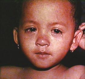 ILMU FARMASI: EPIDEMIOLOGI PENYAKIT CAMPAK (MORBILI atau MEASLES)