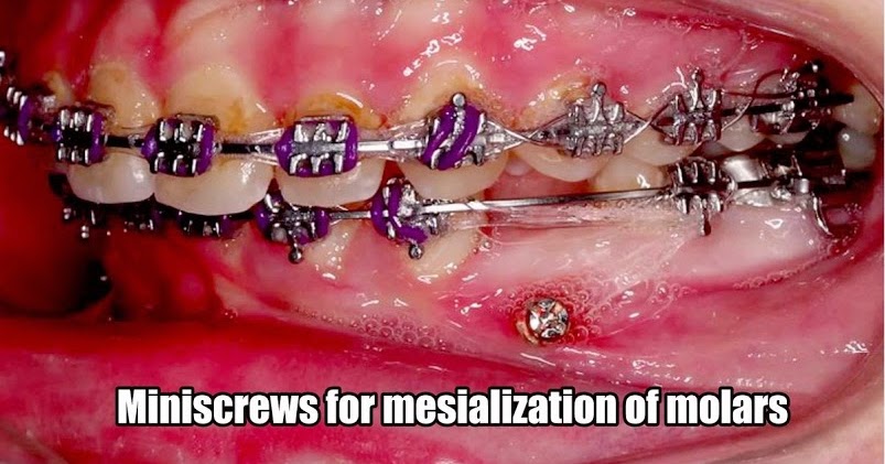 ORTHODONTICS: Installing miniscrews for mesialization of molars in the ...
