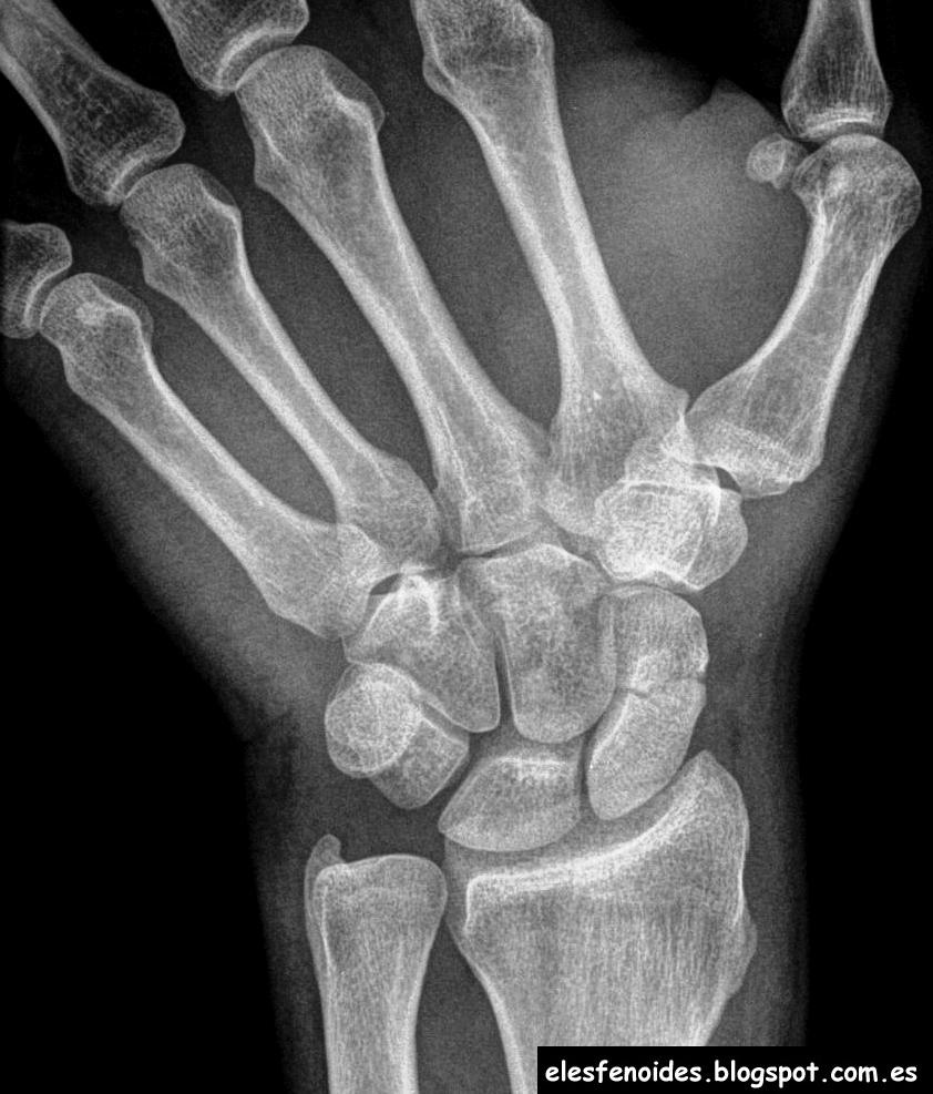 El esfenoides: Fractura de escafoides. 2 imágenes 1 caso.