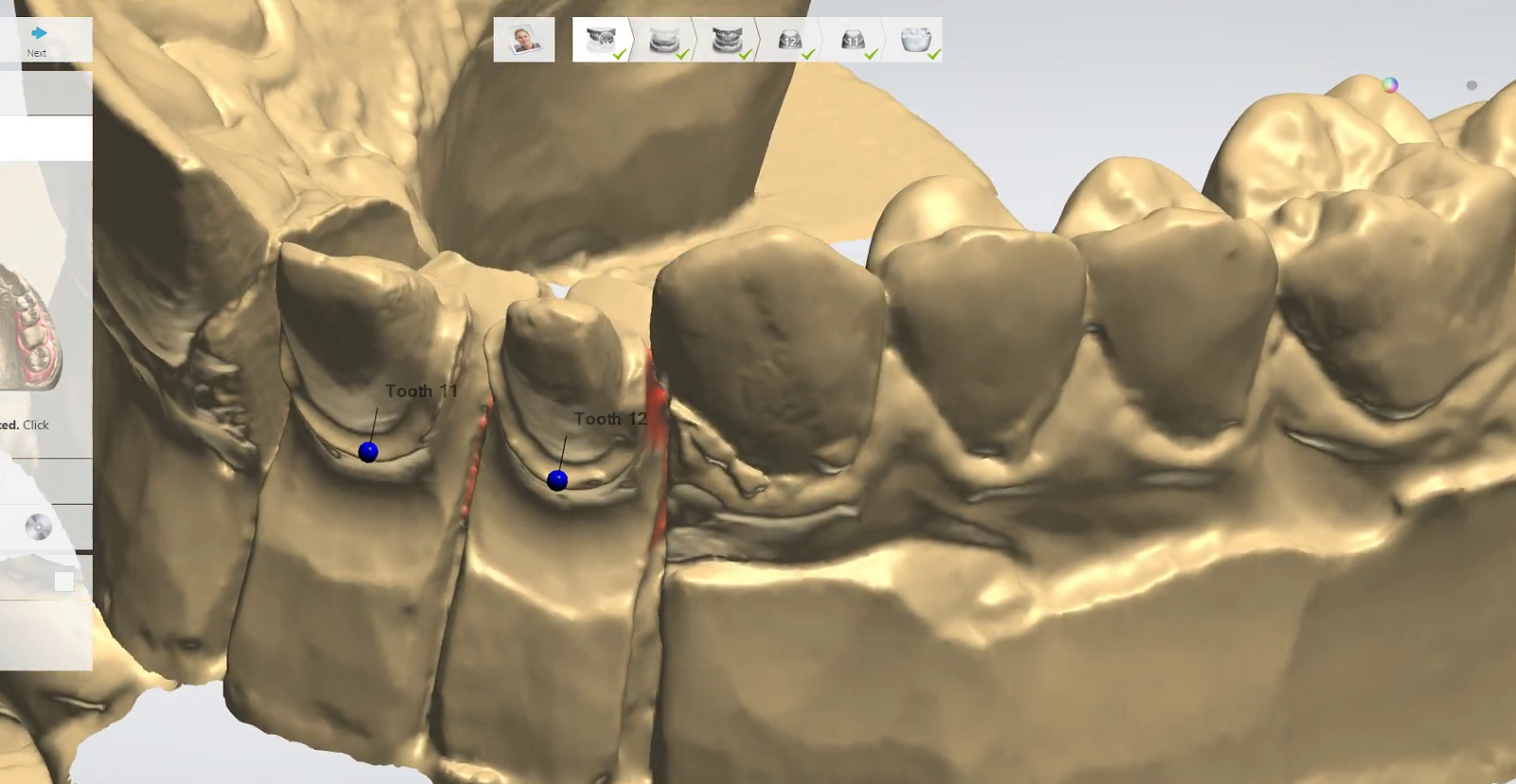 Precise scan with proclined teeth in 3shape scanner