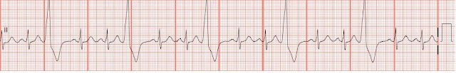 EKG Rhythm Strips 11- ectopic beats