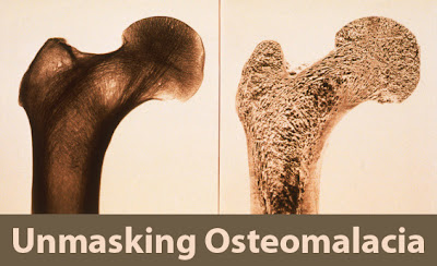 Osteomalacia causes, pathogenesis, diagnosis and treatment