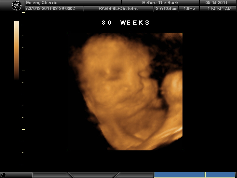 Making mEmerys: 3D/4D Ultrasound-30 Weeks