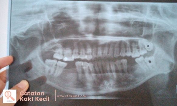 √Pengalaman Operasi Gigi Bungsu di Klinik Masa Pandemi