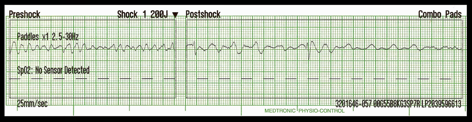 Practice EKG Strips 393