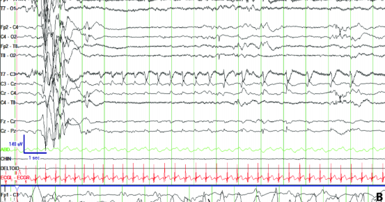 Pediatric Neurology Neonatal Sirpids A Confusing Eeg Finding