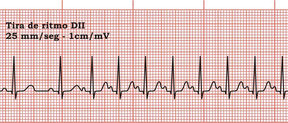 Yo Y Las Circunstancias: Taquicardia por reentrada en el nódulo sinusal