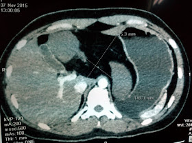 VIETNAMESE MEDIC ULTRASOUND: CASE 358: LESSER OMENTUM TUMOR, Dr PHAN ...