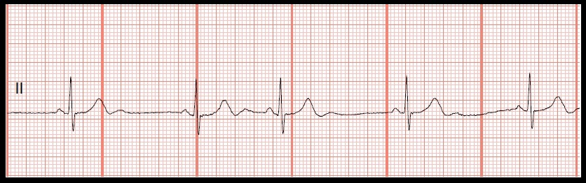 Practice EKG Rhythm Strips 126