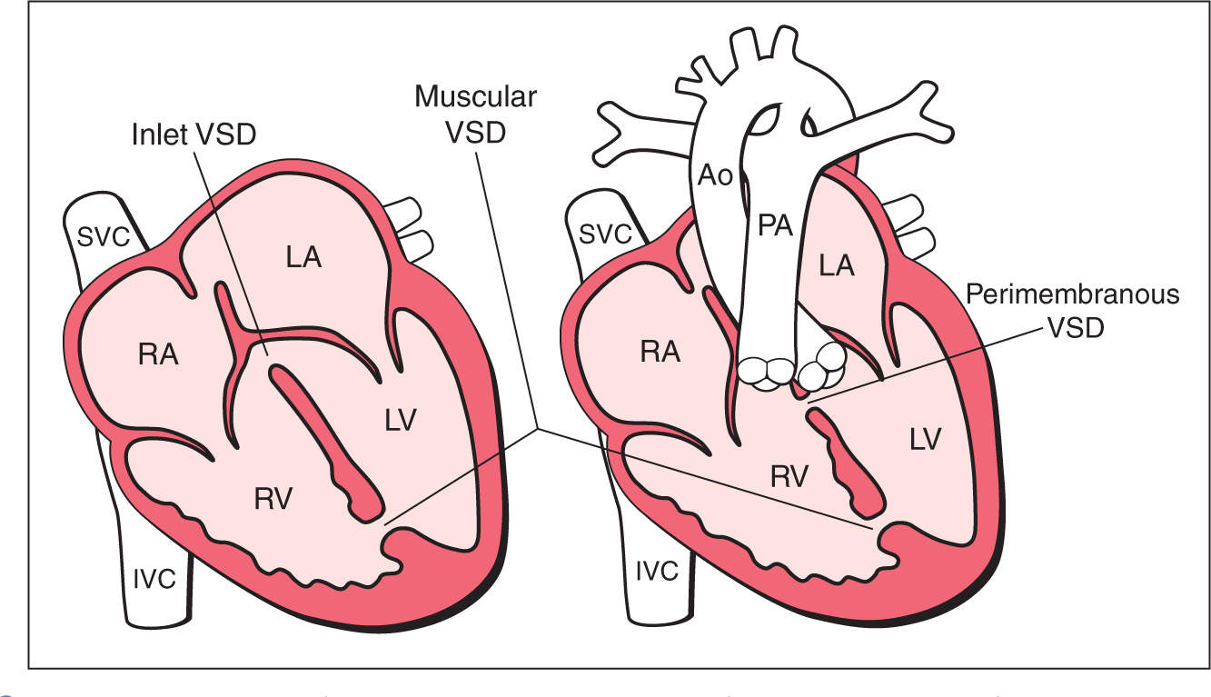 Siêu âm Tim Thai Thông Liên Thất Ventricular Septal Defects Vsds Bác Sĩ Võ Tá Sơn