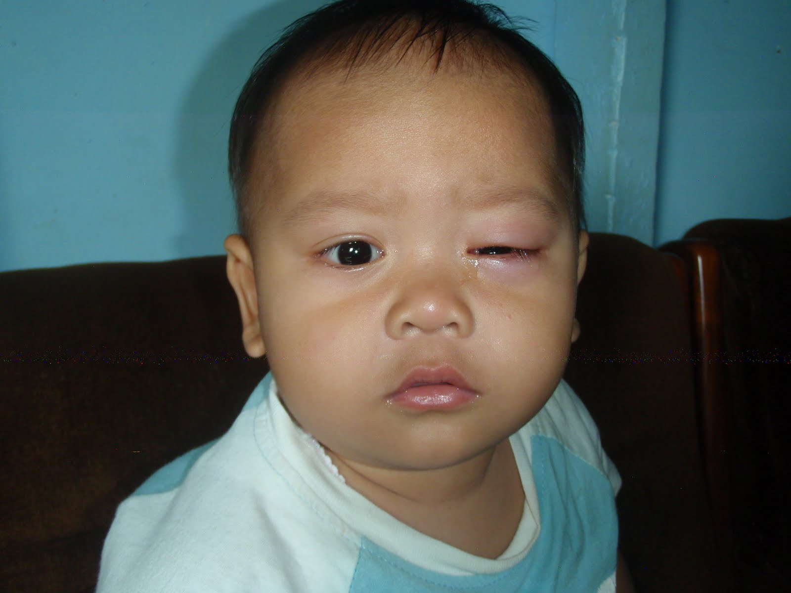 Sakit Mata Bengkak - Perumperindo.co.id