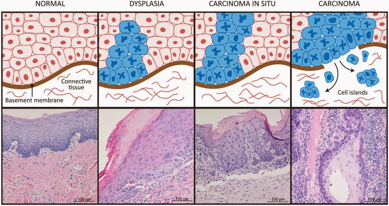Leucoplasia, Eritroplasia e Queilite Actínica | Estomatologia Online