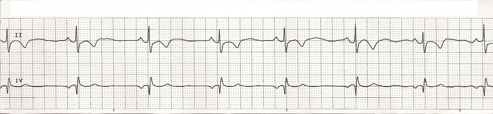 EKG Rhythm Strip Quiz 43