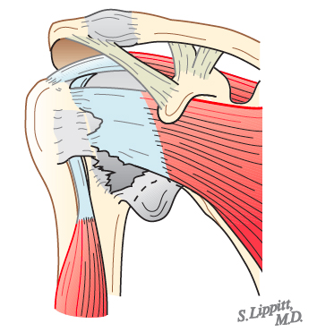 UW Shoulder and Elbow Academy: Subscapularis tendon tearing