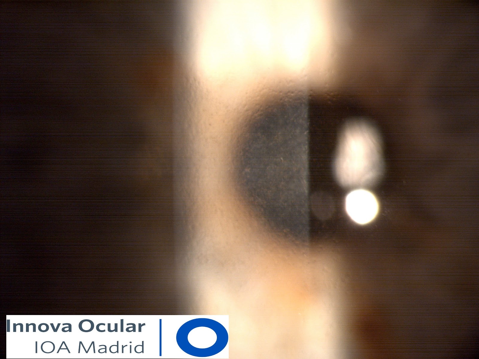 Miranza IOA: CÓRNEA GUTTATA. DISTROFIA ENDOTELIAL DE FUCHS