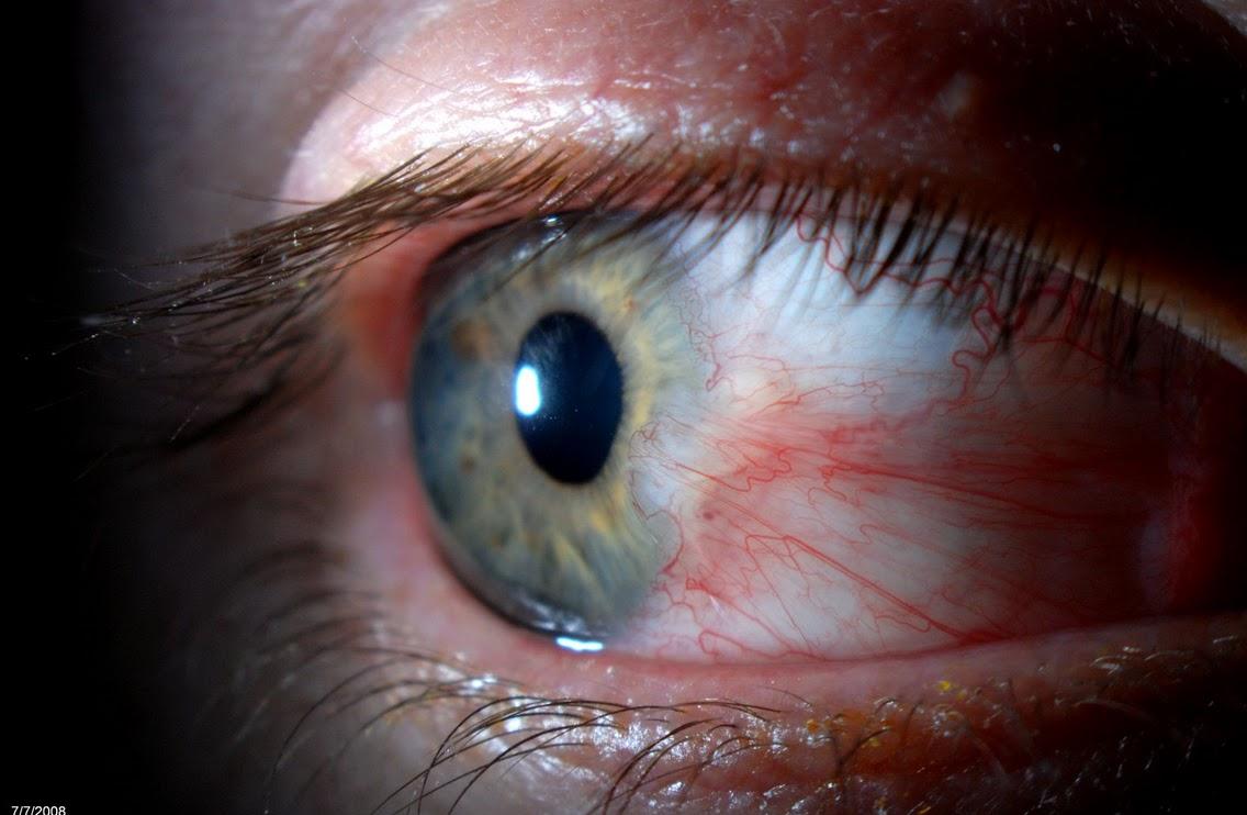 Images For Pterygium ~ YOUNG DOCTORS' RESEARCH FORUM
