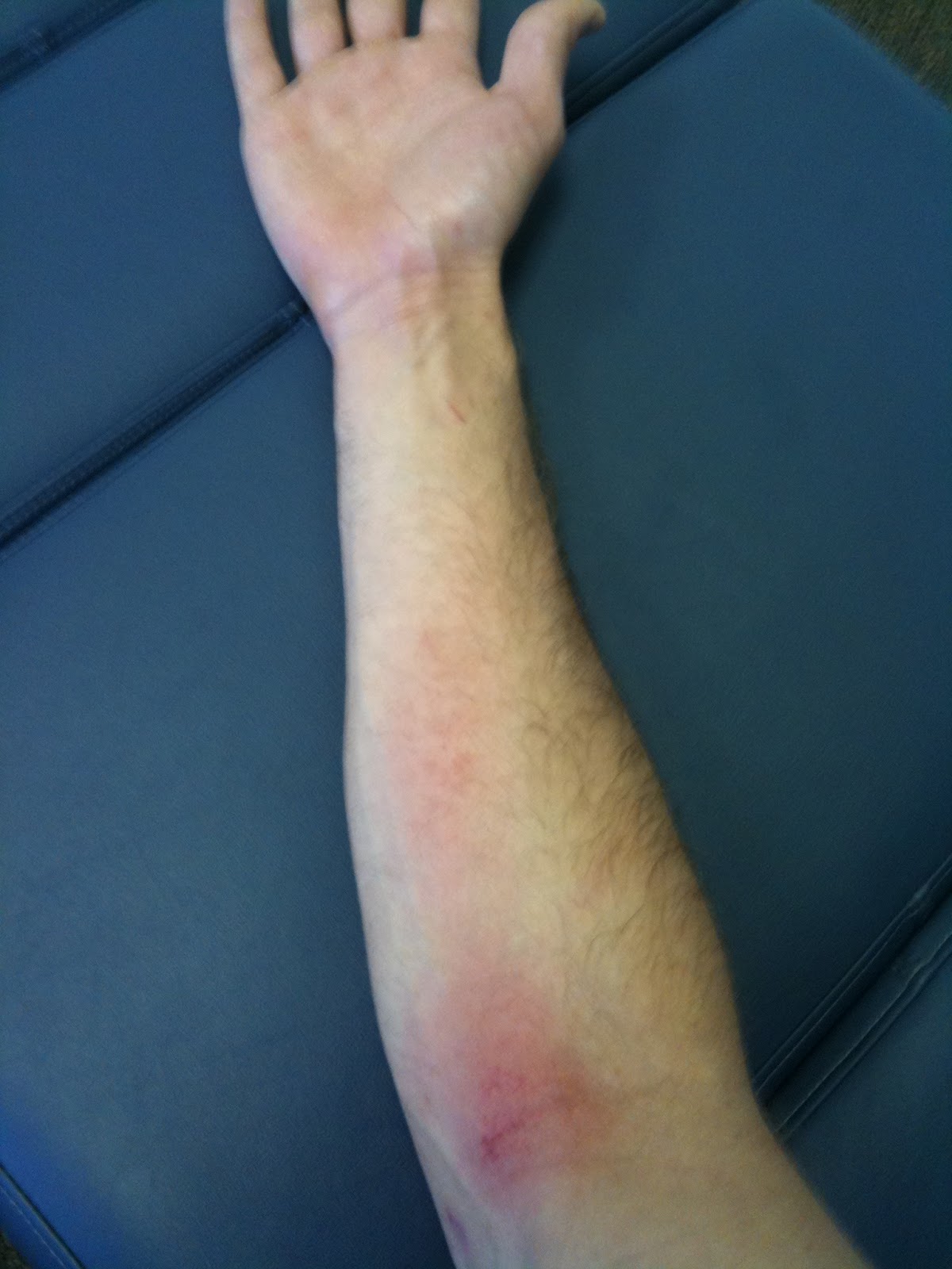 Positive Edge Chiropractic's Blog: Instrument Assisted Soft Tissue ...