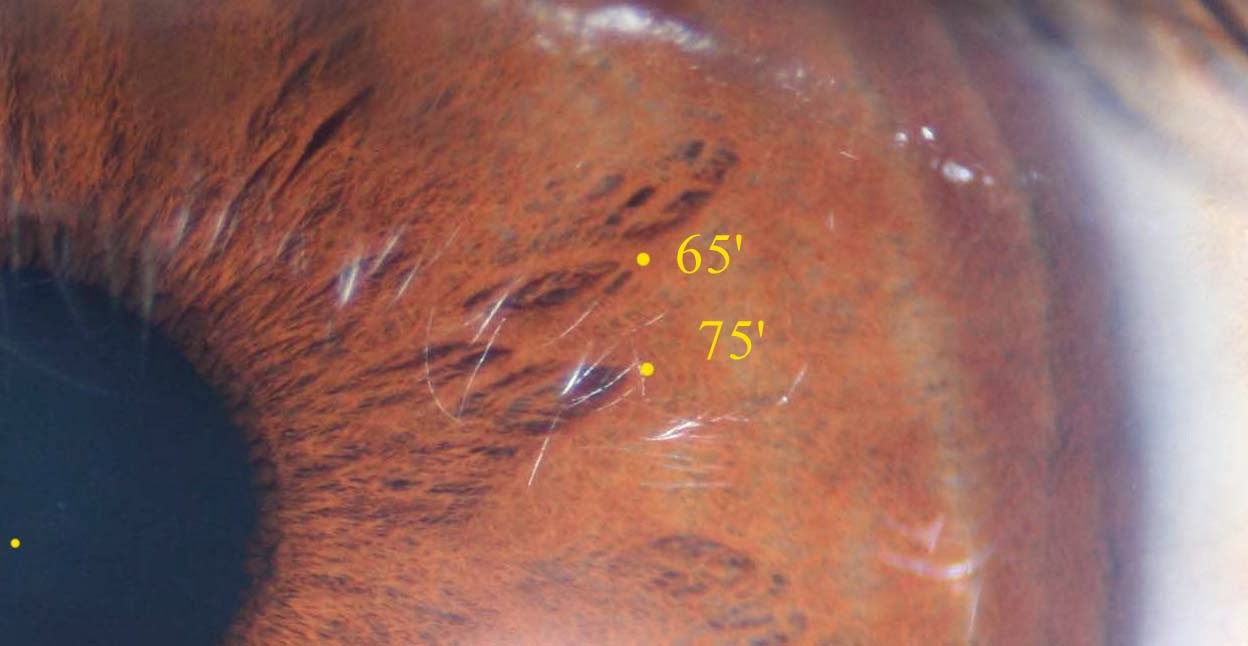 Modern & Multidimensional Iridology: The Inner Pupillary Border ...