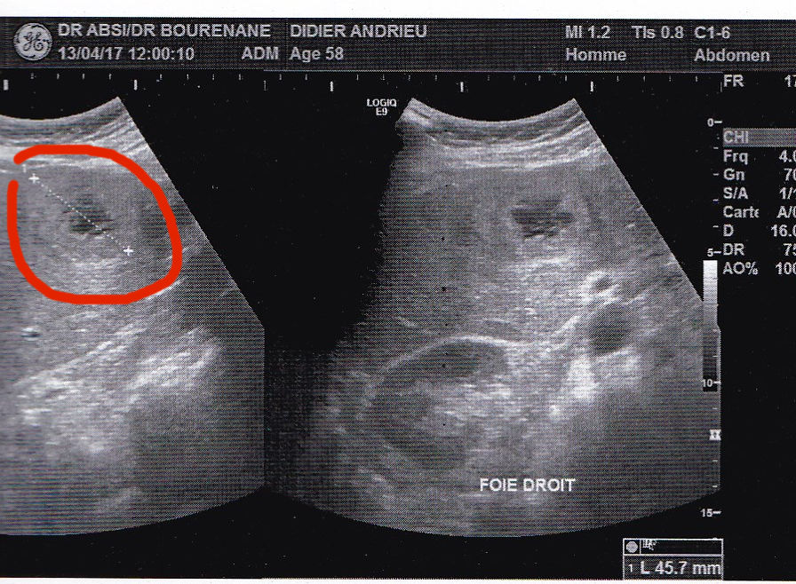 cancer de la prostate: Echo ....