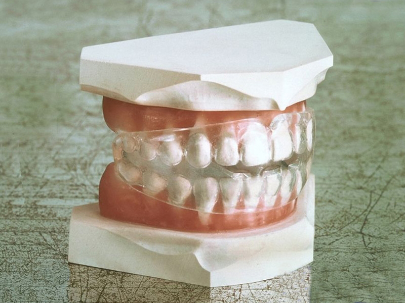 Dental sky - All about healthy smile: Tooth Positioners For Smile Designing