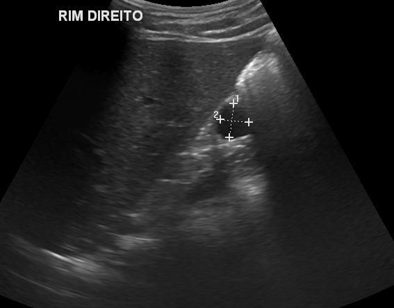 Radiologia Pediátrica: Atrofia renal associada a rim vicariante contra ...