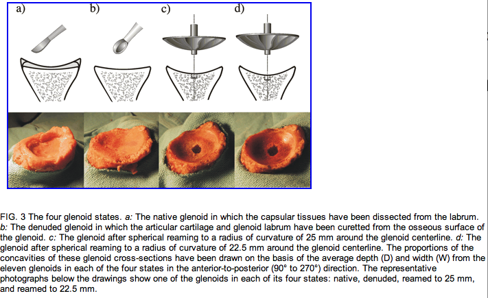 Shoulder Arthritis / Rotator Cuff Tears / Shoulder Pain : Ream and Run ...