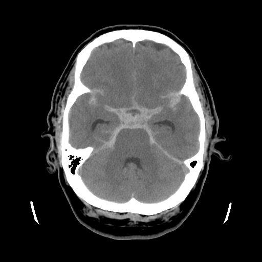 X-RAYview: Hemorragia SUBARACNOIDEA