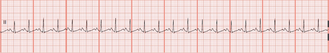 EKG Rhythm Strip Quiz 80