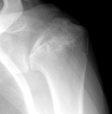 UW Shoulder and Elbow Academy: Hemiarthroplasty for avascular necrosis