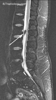 RiT radiology: Lipoma of Filum Terminale