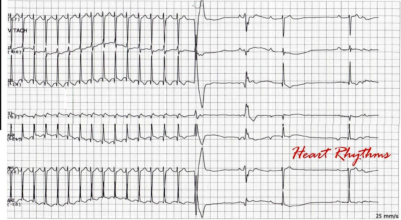 ECG Rhythms: SVT (probably AVNRT) with spontaneous normalization