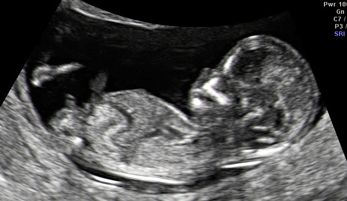 My Greatest Journey: 11 weeks baby- FOR HUBBY