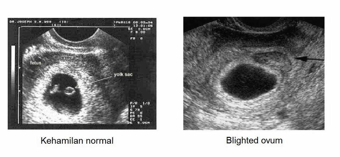 datinsha.blogspot.com: Kantung Kosong ~ 7 weeks