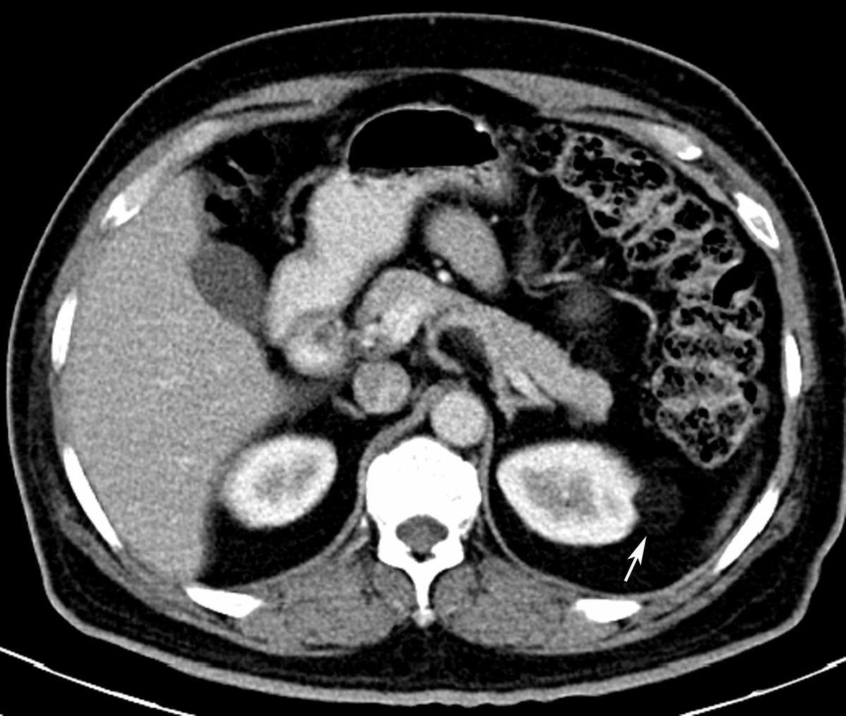 Radiodiagnosis - Imaging is Amazing-Interesting cases: Renal ...