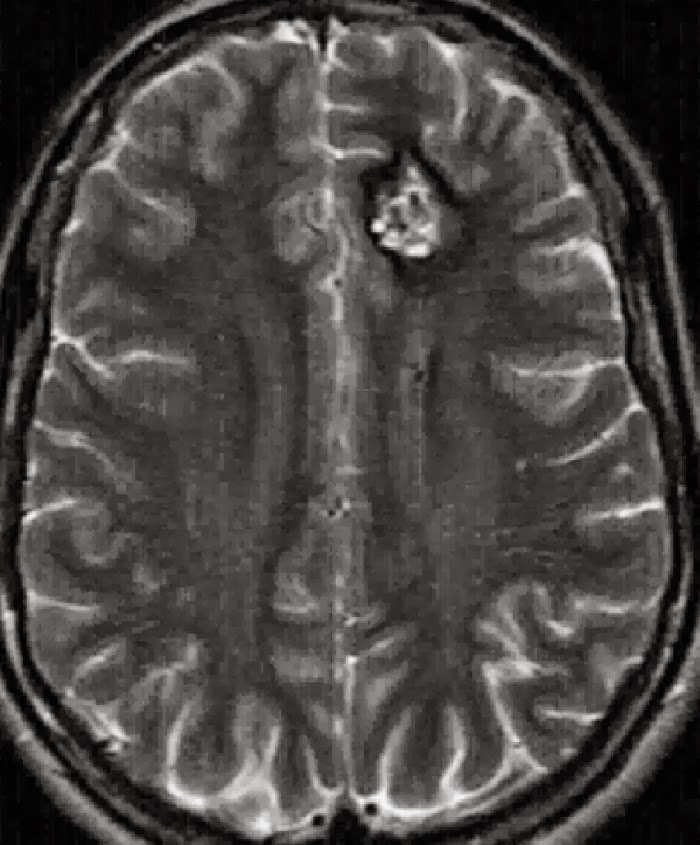 Ultimate Radiology : Multiple Cavernomas in Brain
