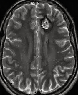 Ultimate Radiology : Multiple Cavernomas in Brain