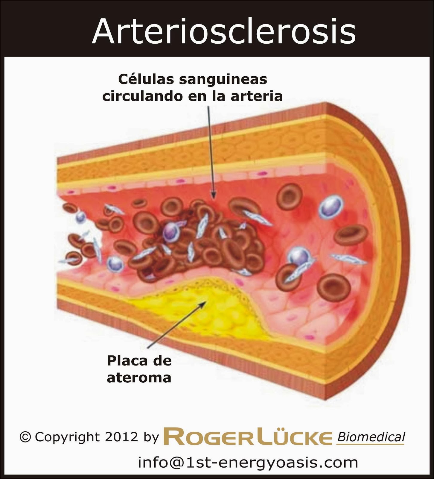 Entrevista: La aterosclerosis ...una enfermedad prevenible y tratable