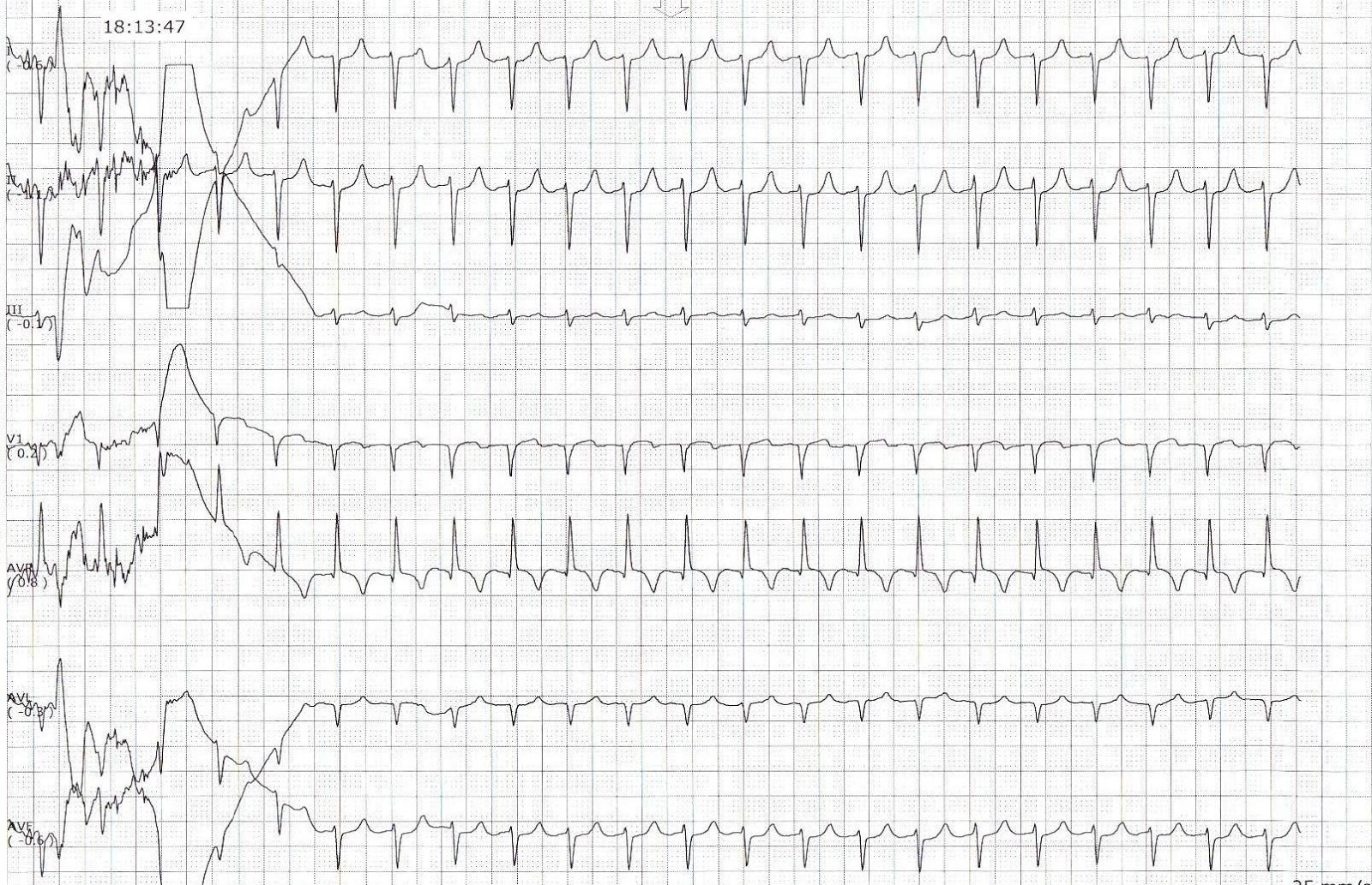 Download Ecg Rhythms Live