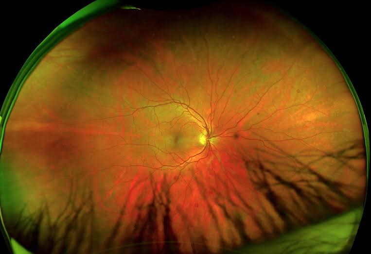 How Retinal Imaging Can Save a Life: A Case Study - Eyedolatry