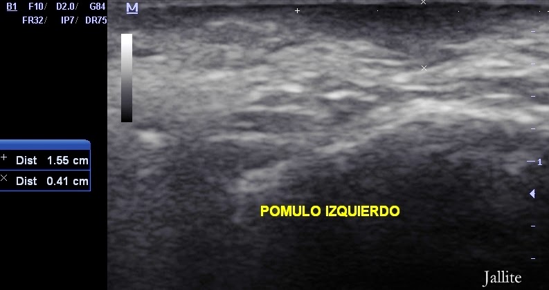 Abscesos Multiples en Cara