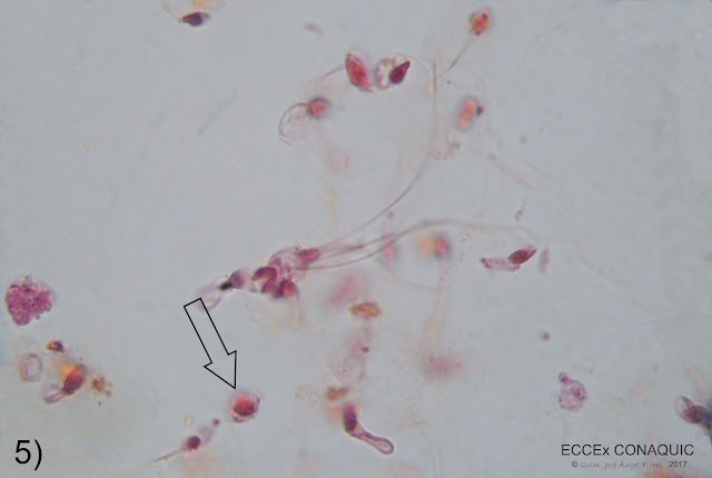 Caso UR-mayo-17 (Enfoque: celularidad)