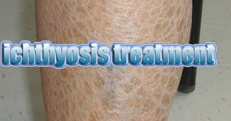 Ichthyosis vulgaris natural treatment, Ichthyosis Vulgaris or Fish Skin ...