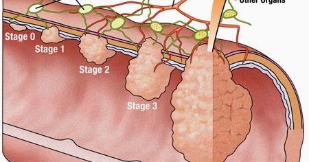 Things You Need to Know About Colorectal Surgery....: You’ve Been ...