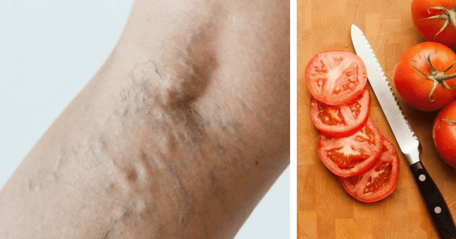 Cómo reducir la inflamación y los dolores de las varices con tomate