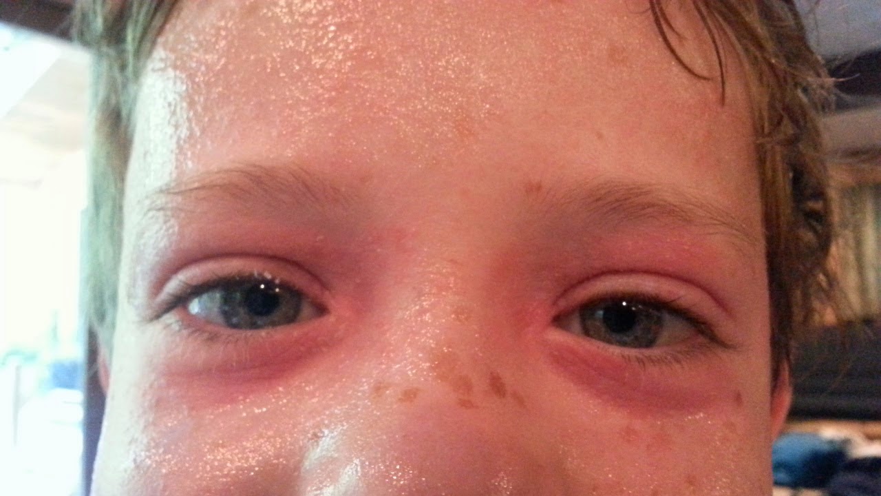 David McNally - Wiskott Aldrich Syndrome, Bone Marrow Transplant, and ...