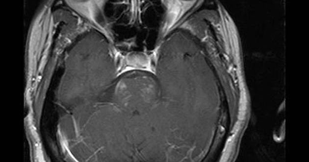 neuropathology blog: CLIPPERS: chronic lymphocytic inflammation with ...