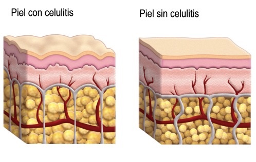 Es una condición que ocurre en la capa subcutánea de la piel de las ...